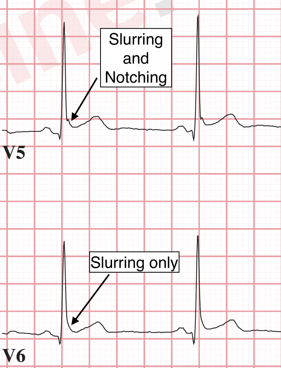 J Point Notching And Slurring